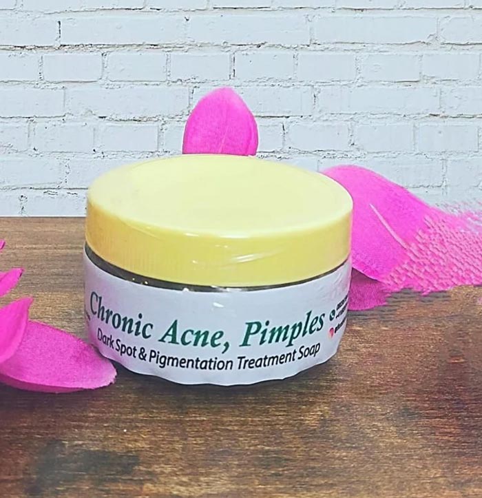 Chronic Acne Pimples - The TJCollectibles